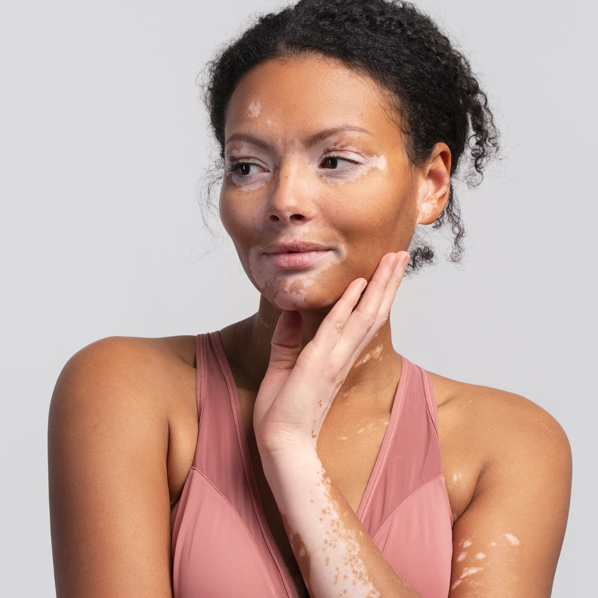 generalized vitiligo types