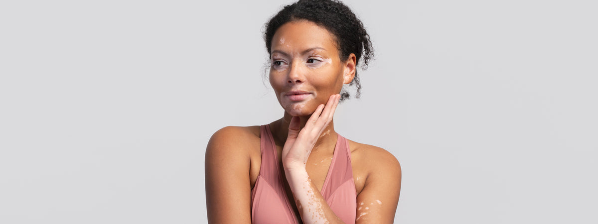 Vitiligo: Types, Symptoms, Causes, and Treatment